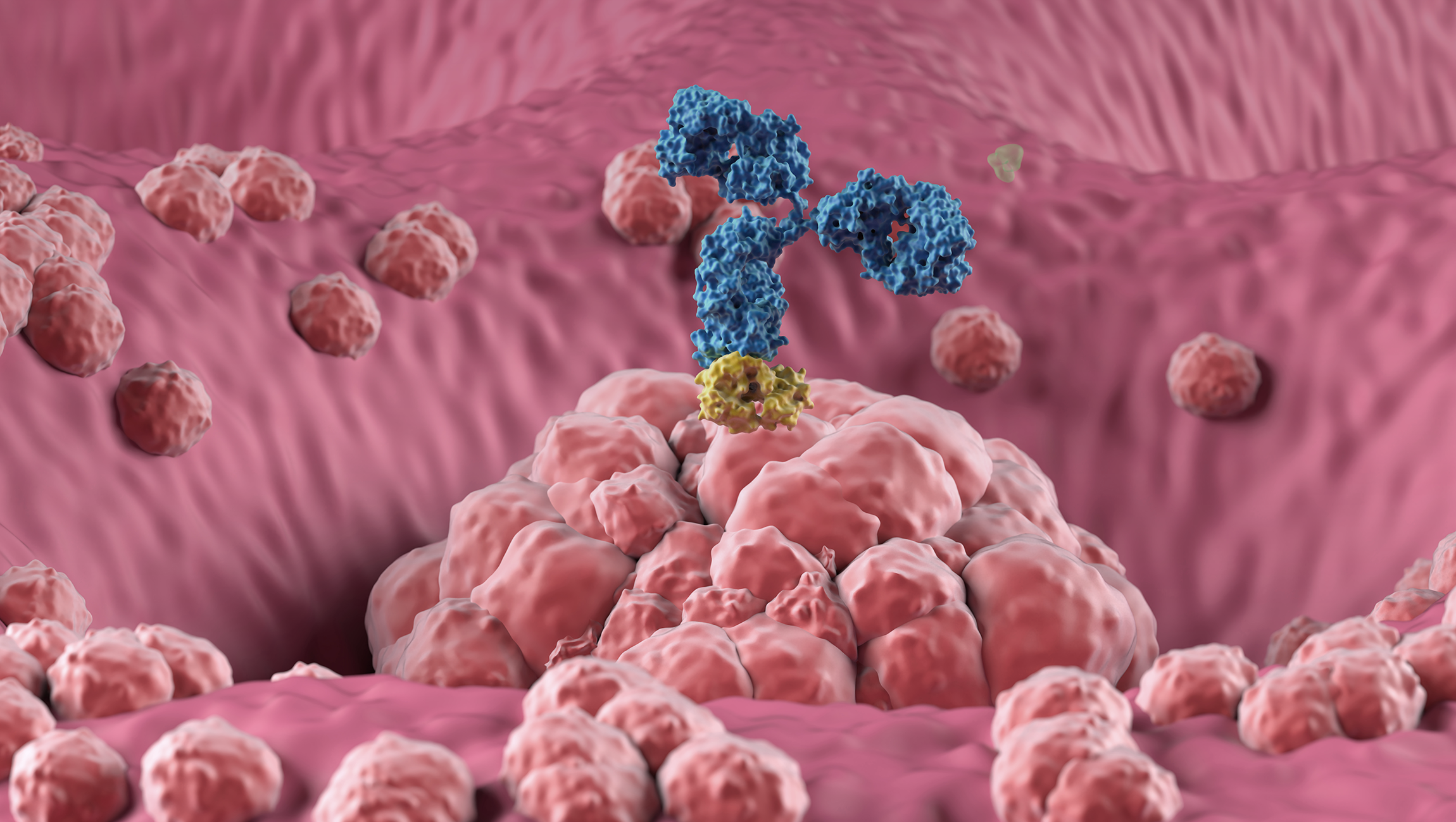 CME: Immunotherapy, gastric cancer, GEJ cancer, zolbetuximab