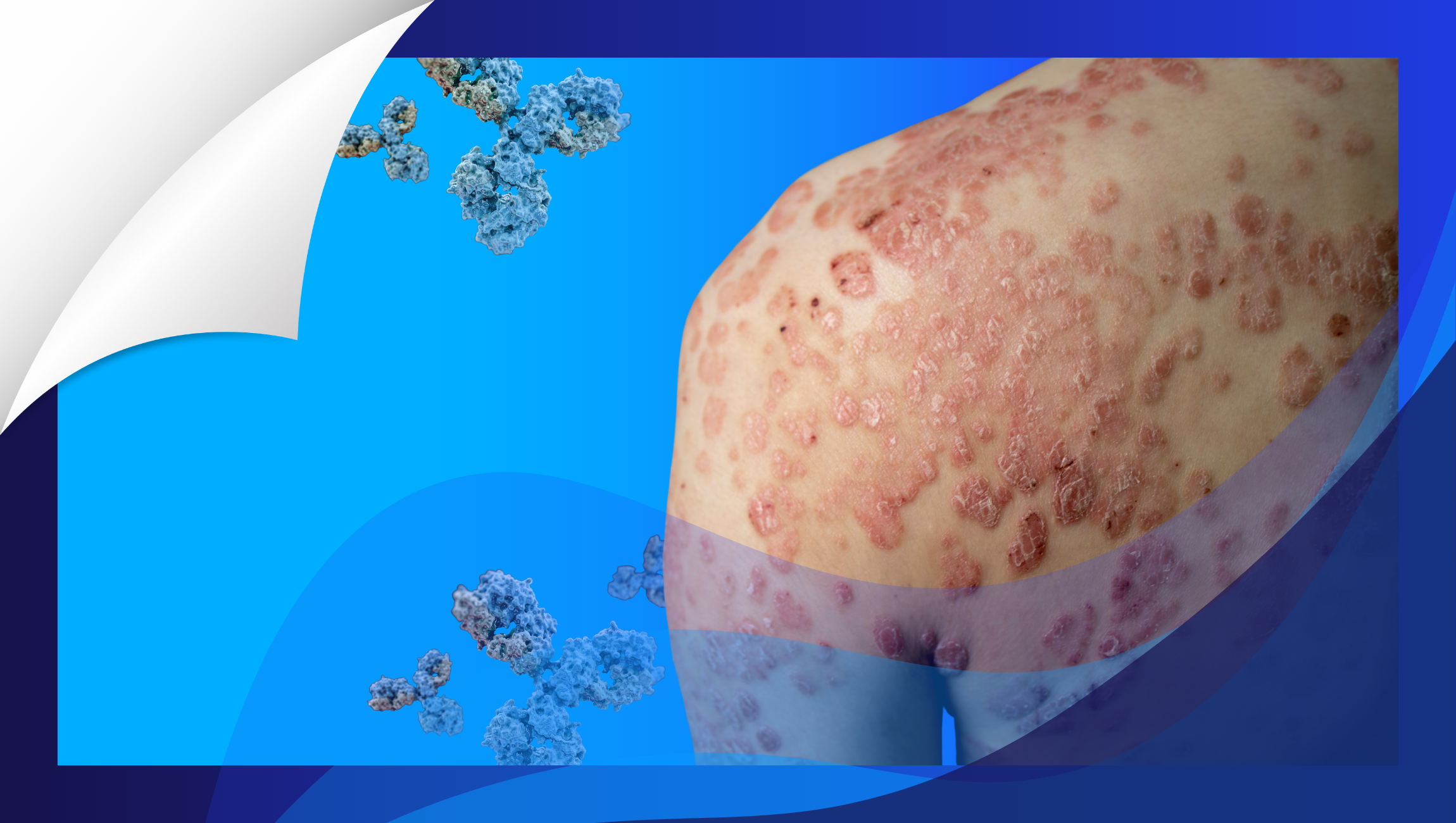 Real-World Data Highlights Class-Based Differences in Psoriasis ...