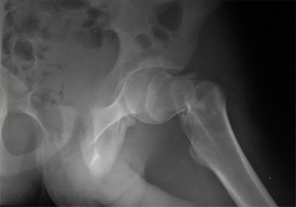 Surgical Breakthroughs In Hip Osteoarthritis Medical Education on ReachMD