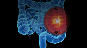 Redefining Mucosal Healing in IBD: Updated Goals of Therapy Medical ...