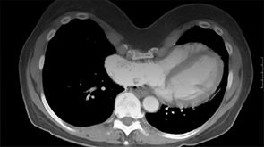 Pectus Excavatum: Research Advances Guiding Surgical Innovations ...