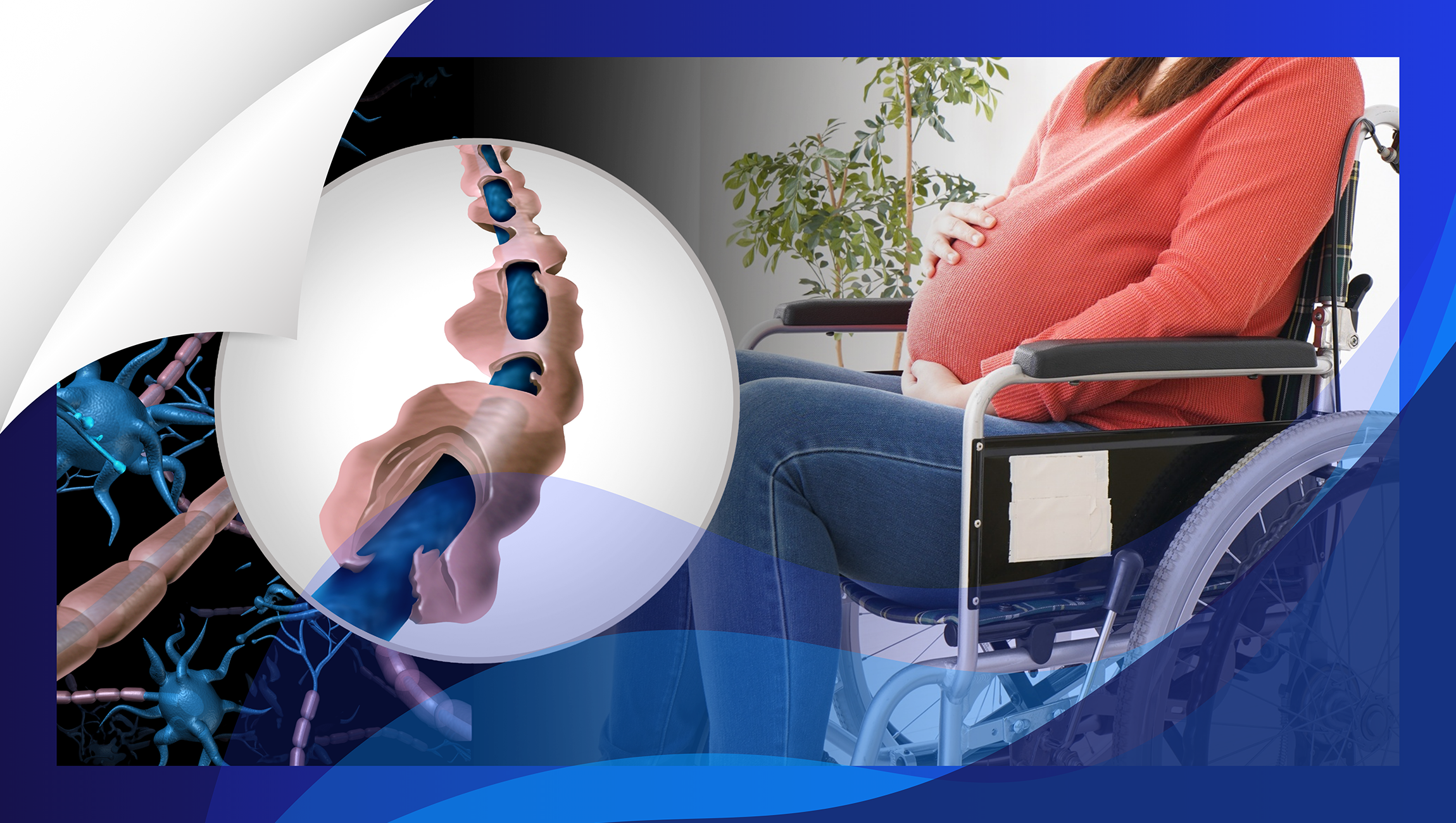 Pregnancy and Infant Outcomes in Multiple Sclerosis: Findings from the ...